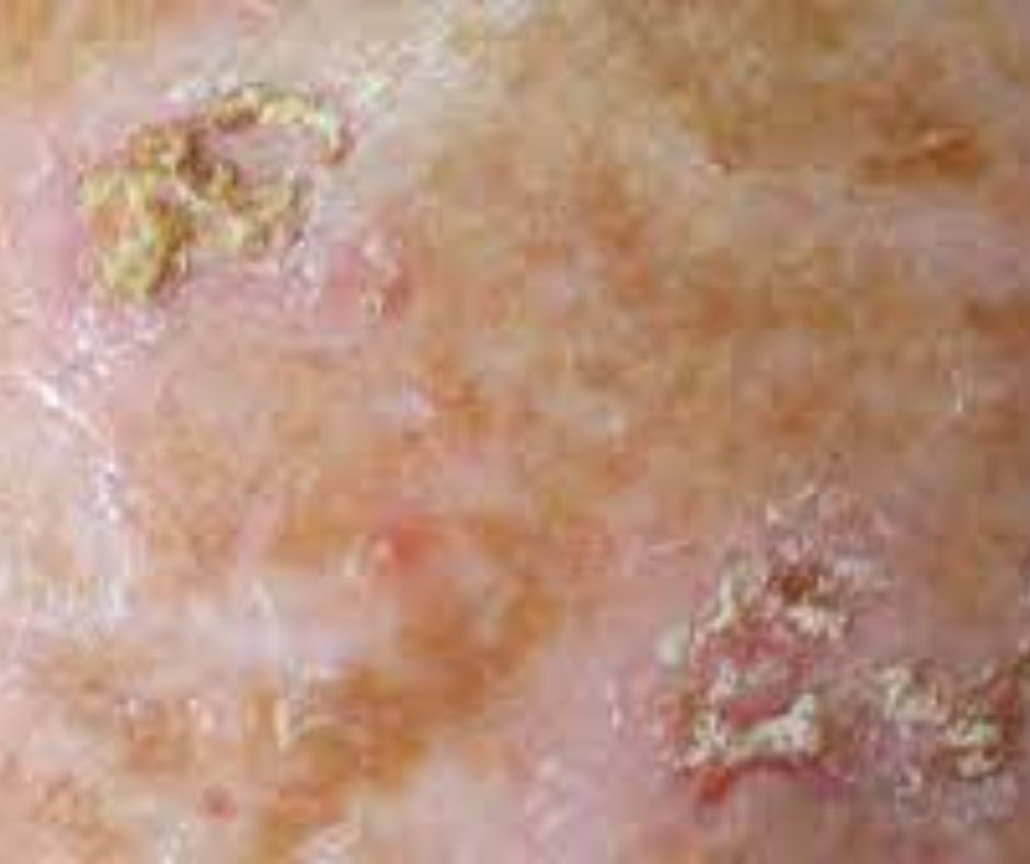 Úlceras en la piel en personas mayores - Durcal Blog